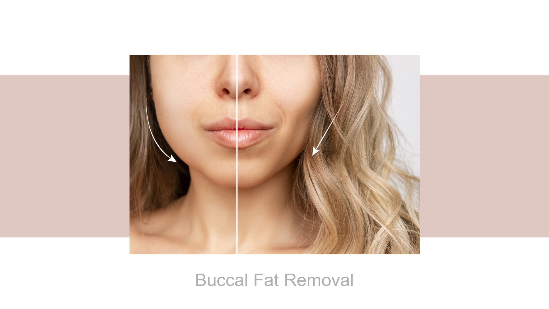 Buccal Fat Removal
