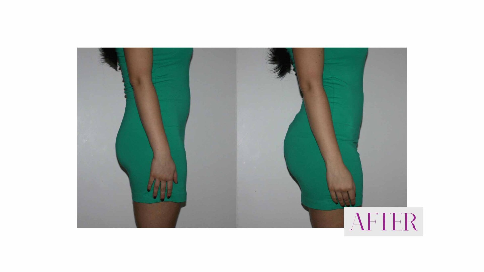 Brazilian Butt Lift Surgery in Abu Dhabi | Buttock Lift in UAE