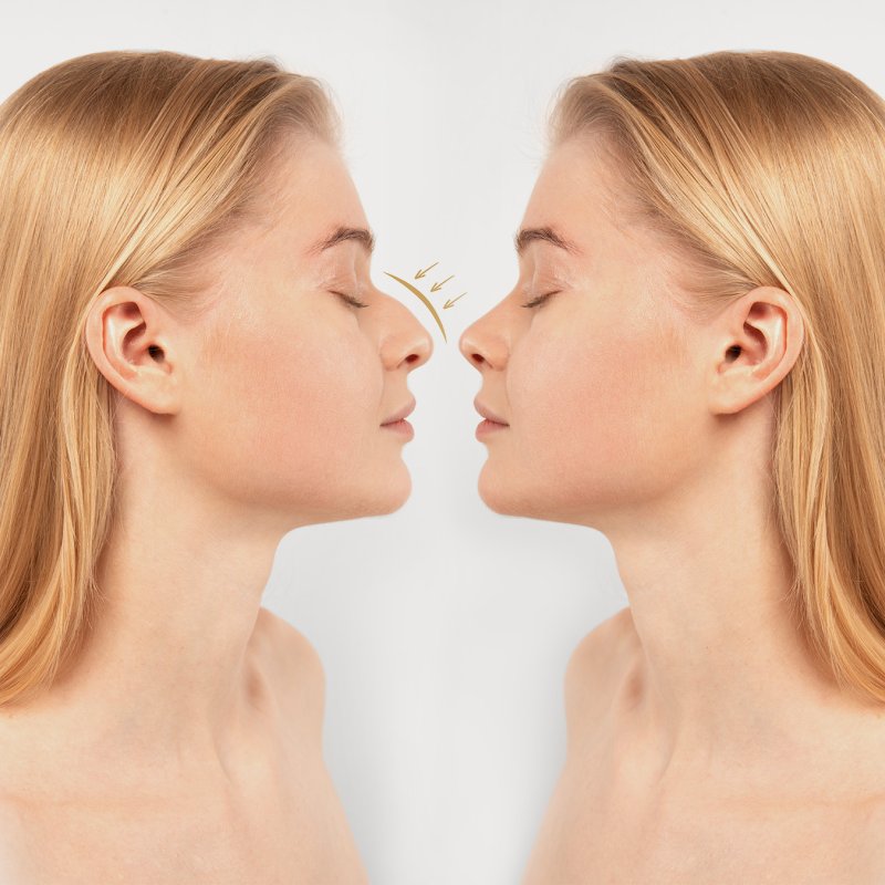 Nose Job - Rhinoplasty