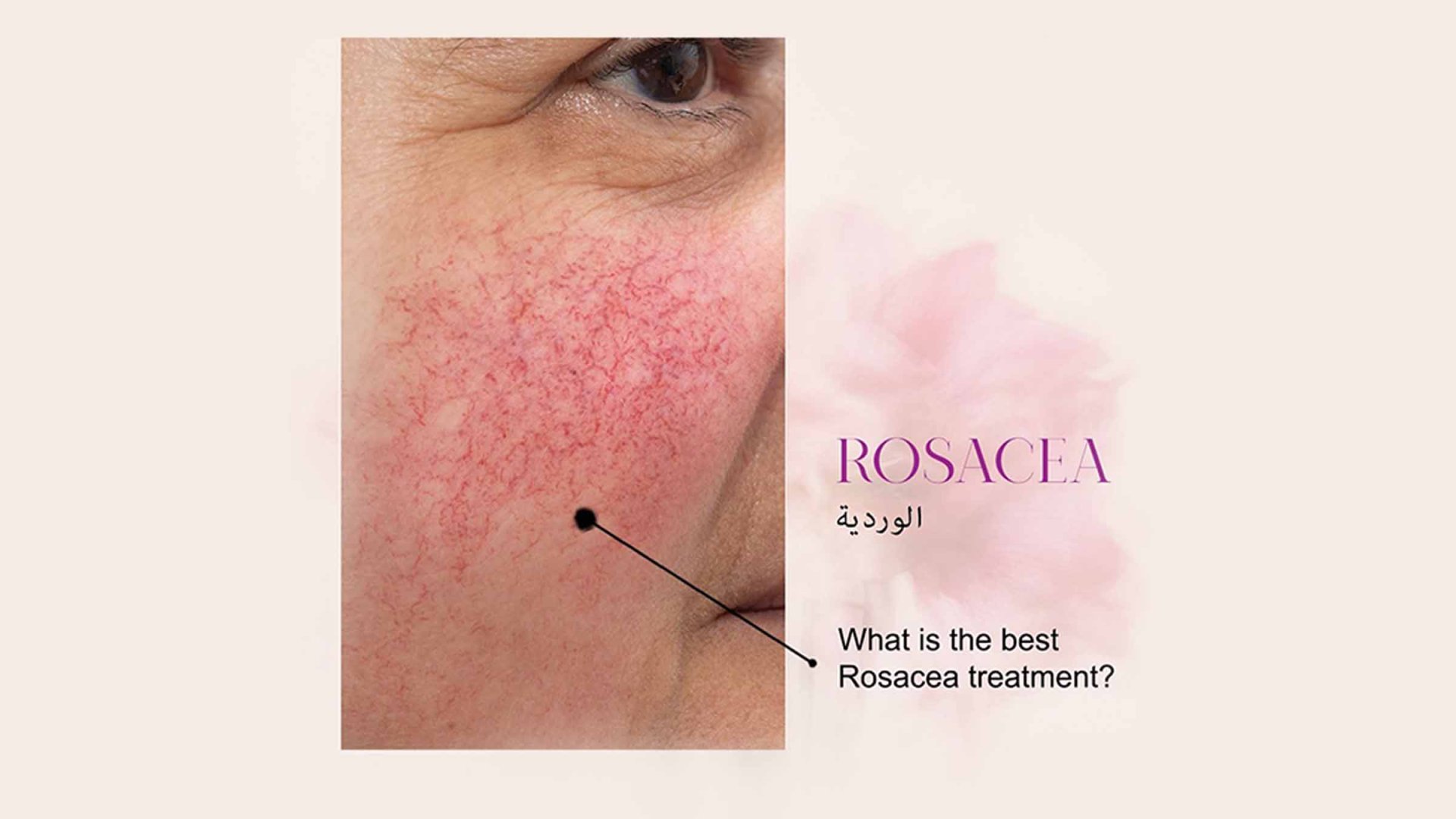 Rosacea Treatment