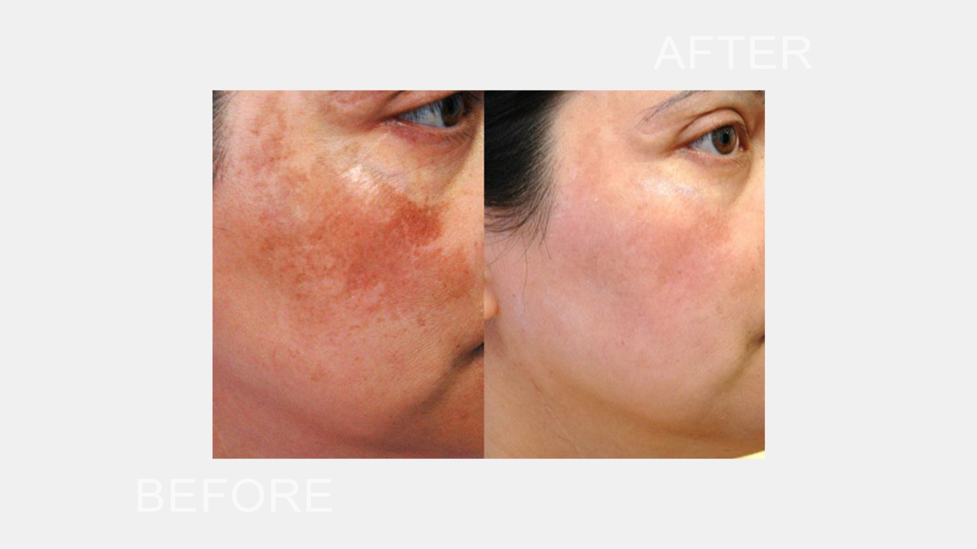 Skin Pigmentation Treatment