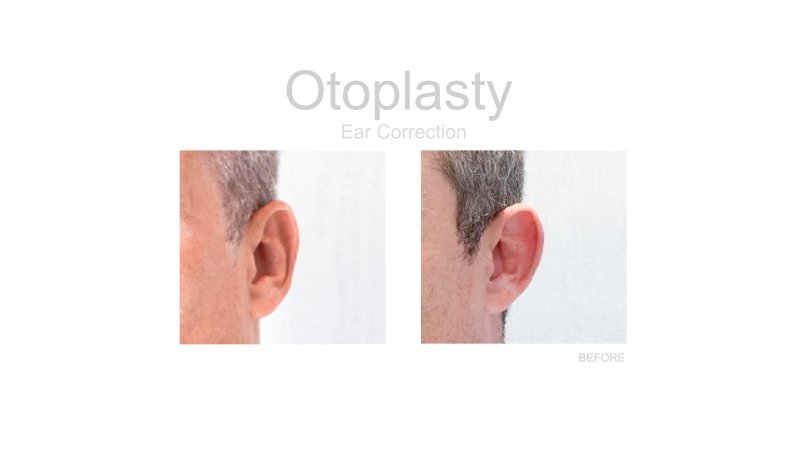 Ear Correction - Otoplasty